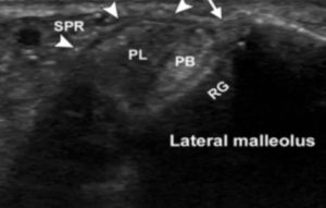 Case study – Peroneal tendon injury - Sports Medicine Ultrasound Group